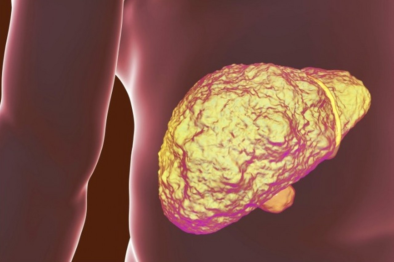 Siroz nedir, neden olur, belirtileri nelerdir, tedavisi nasıl yapılır ...