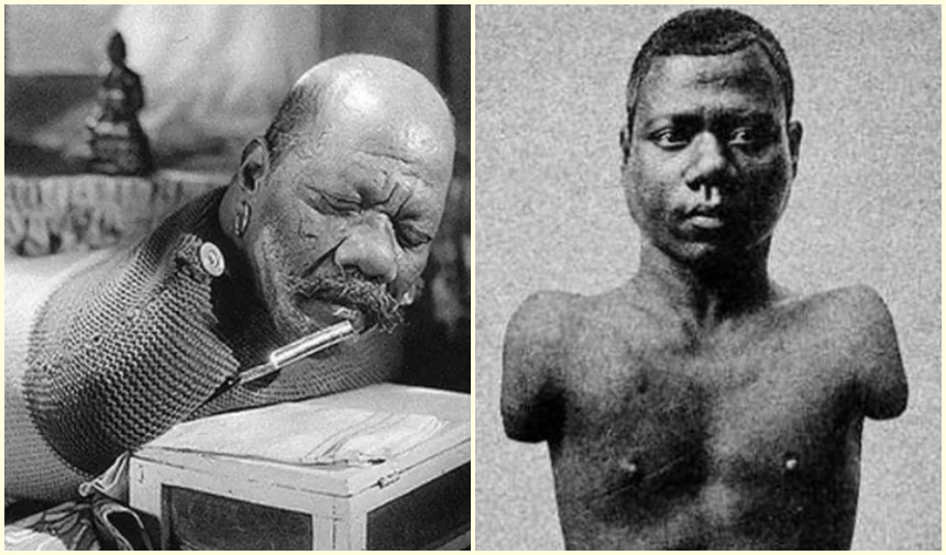 Yaşayan Gövde Lakaplı Prens Randian: Engelleri Sanatla Aşan Bir Hayat ...